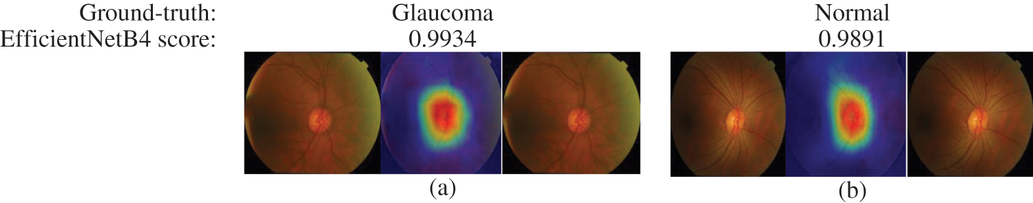 Classification of Glaucoma in Retinal Images Using EfficientnetB4 Deep ...