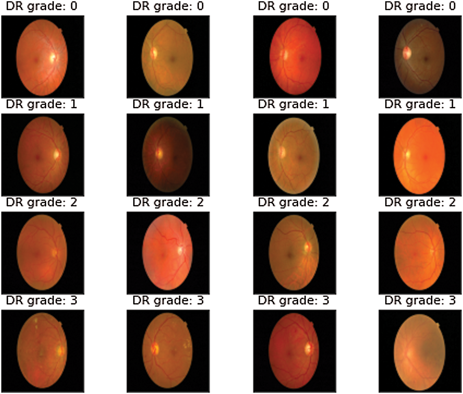 A Novel Optimizer in Deep Neural Network for Diabetic Retinopathy ...