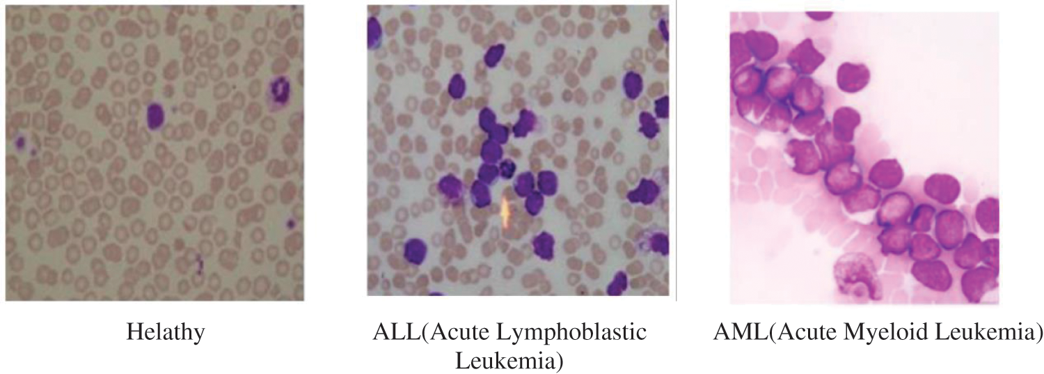 Classification of Bone Marrow Cells for Medical Diagnosis of Acute Leukemia