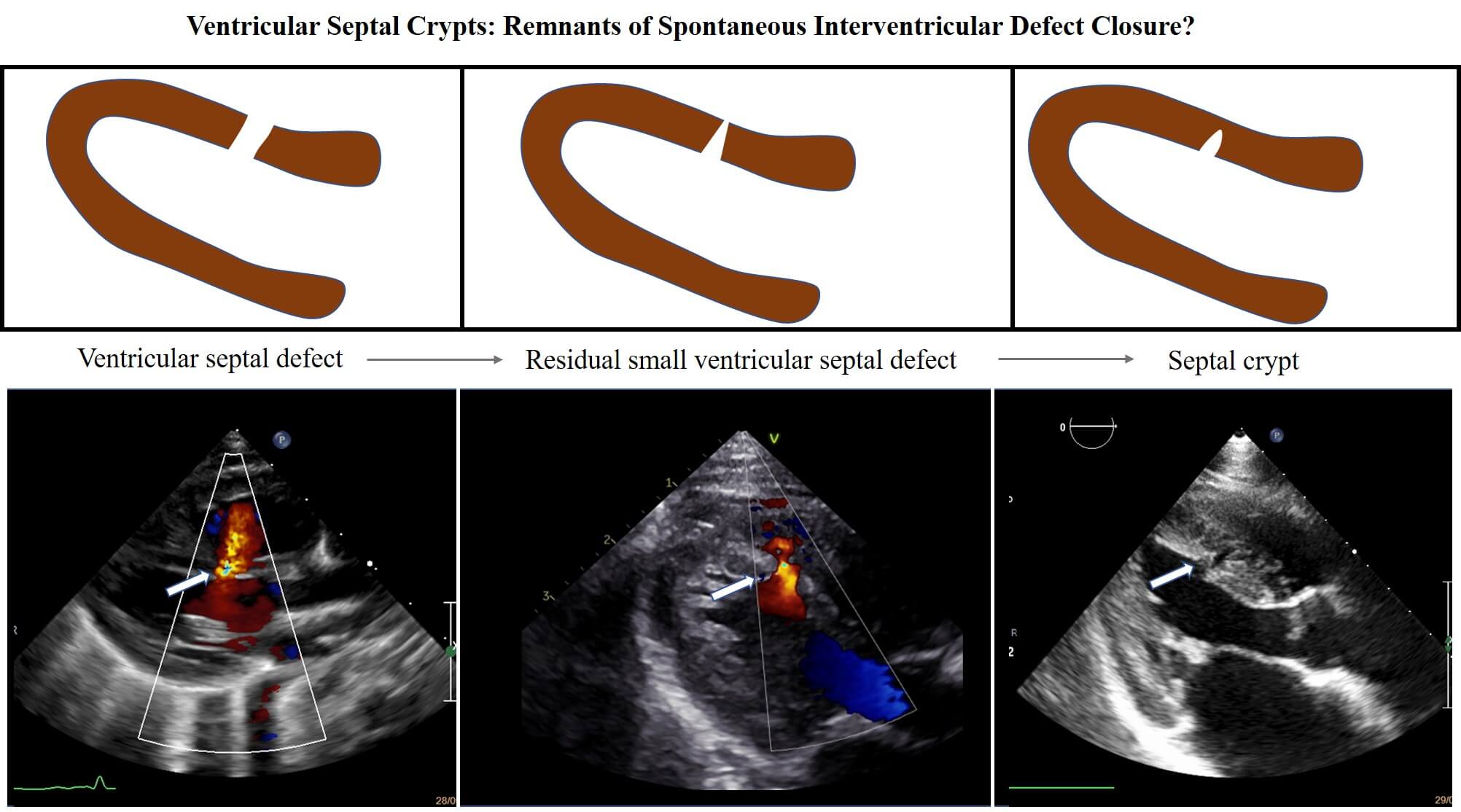 Ventricular Septal Defect